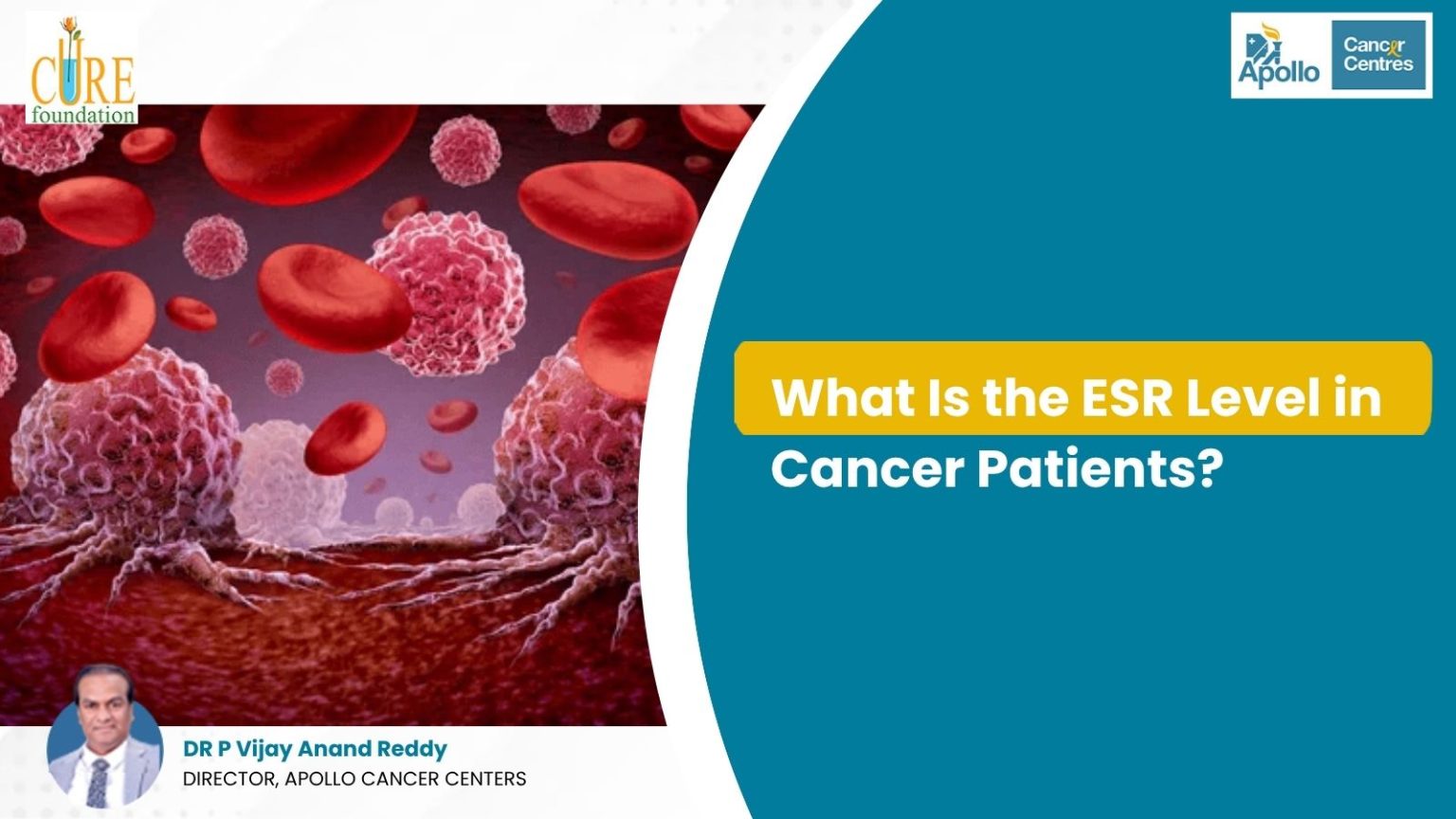 What Is the ESR Level in Cancer Patients? - Dr Vijay Anand Reddy